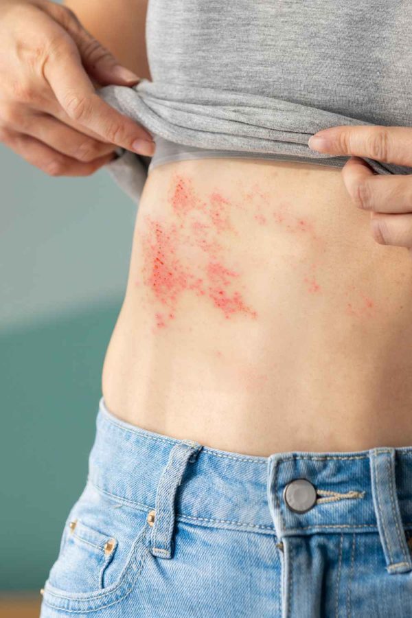 Don't Be Fooled: How to Tell Shingles Apart from Chickenpox in Children